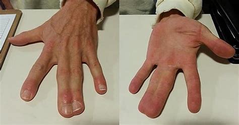 Fingers Stuck Together Imgur