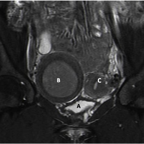 2d Transvaginal Pelvic Ultrasonography A Left Unicornuate Uterus B