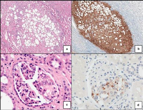A B Microscopic Angiomyolipoma Displaying Strong Cathepsin K