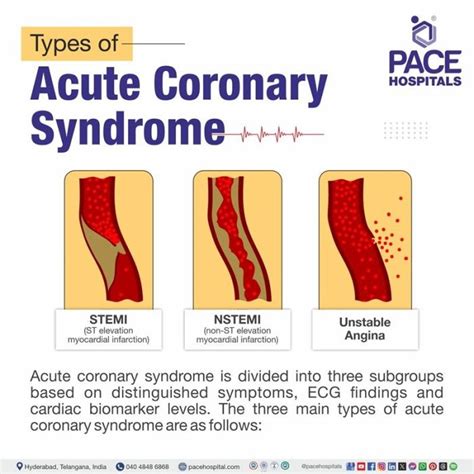 Penjelasan Nstemi Gejala Penyebab Dan Pengobatannya