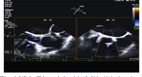 Figure 3 From Restrictive Perimembranous Ventricular Septal Defect With Left To Right Shunt Post