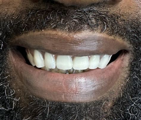 Full Arch Upper Fixed Screw Retained Fp 3 Composite Defect Implant
