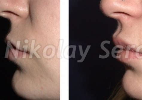 Vy Plasty Lips Before After