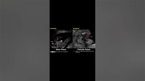 Fetal Gender Determination Ultrasound 18 19 Weeks Male And Female