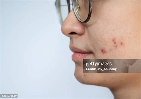 Red Dot On Nose Photos and Premium High Res Pictures - Getty Images