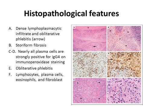 Iv Phlebitis Definition Catheter Related Phlebitis Stages Causes