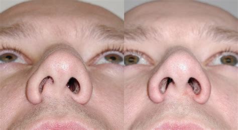 Deviated Nasal Septum Dns
