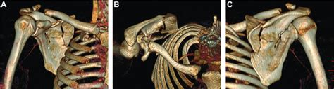3d Ct Reconstructions Further Demonstrating The Scapula Fracture