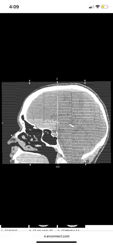 Anyone Experience Slight Deviated Septum That Causes Constant Runny Nose Waiting To Make An