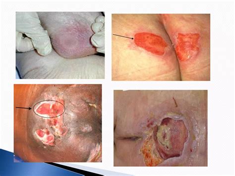 Pressure Ulcers Presentation Ppsx