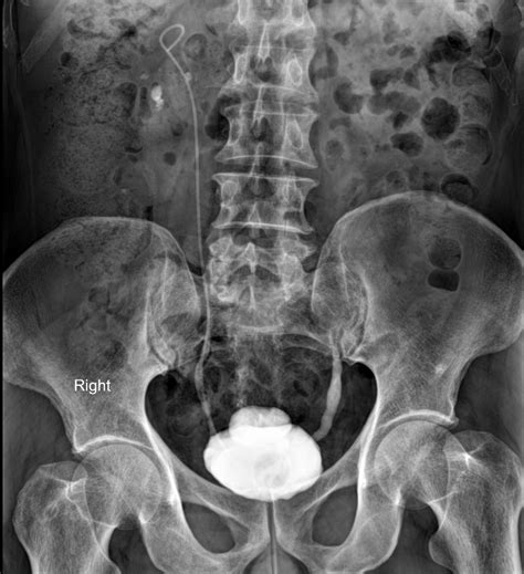 File Colovesical Fistula Due To Diverticulitis Radiopaedia Frontal Oblique And