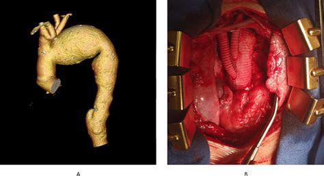 Open Aortic Arch Surgery A Hemiarch Technique B Total Arch