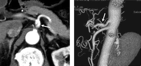 Enhanced Computed Tomographic Ct Cross Section 5 Months After Download Scientific Diagram