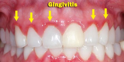 Mild Gingivitis