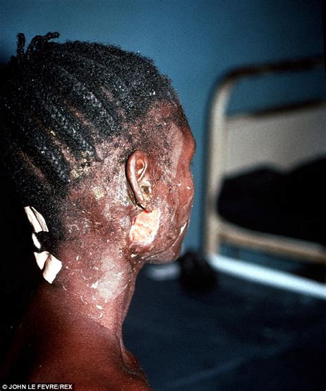 Ebola Bleeding From Pores