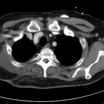 Post Operative CT Scan Showing The Intact Chest Wall And Removal Of