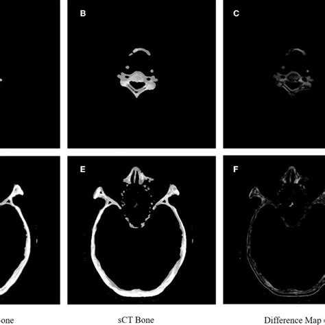 The Comparison Of True Ct And Synthetic Ct For Bone The First Column Download Scientific