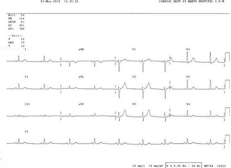 How To Read An Electrocardiogram ECG Part One Basic Principles Of The ECG The Normal ECG