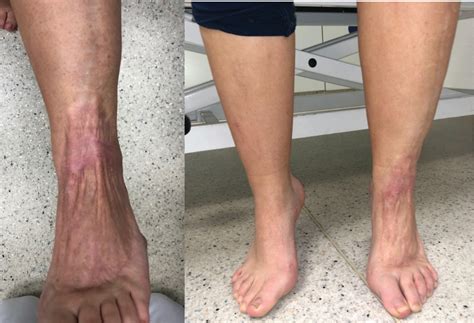 Necrotizing Fasciitis Early Signs