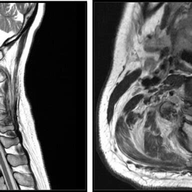Postoperative T2 Weighted Magnetic Resonance Imaging A Sagittal And