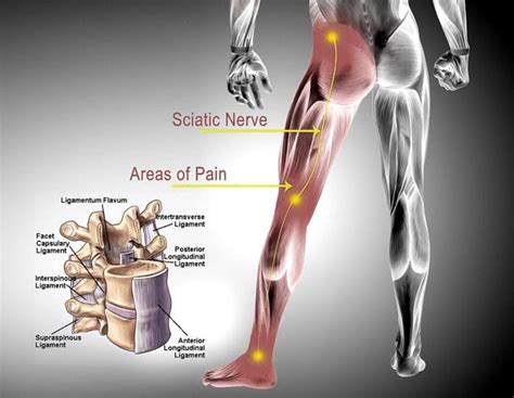 The Sciatic Nerve Pushasrx Athletic Training Centers El Paso Tx