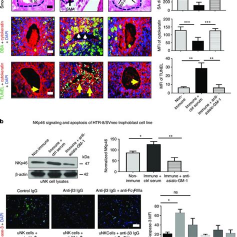 Placental Pathology And Nk Cell Accumulation In The Decidua A At