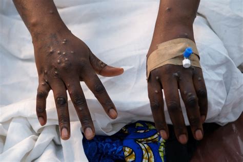 Why Its So Difficult To Get Mpox Vaccines To Areas Facing An Outbreak