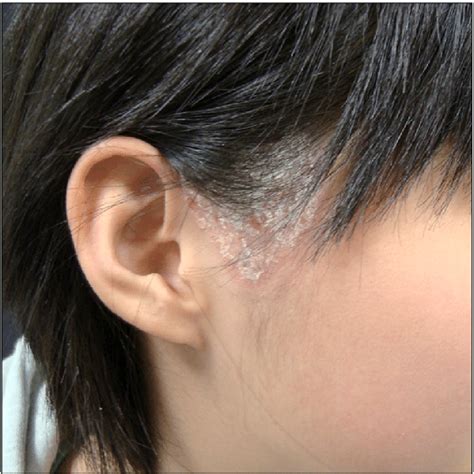 An Erythematous Scaly Plaque On The Scalp Download Scientific Diagram