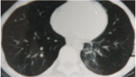 Thorax Ct Showing Reticulonodular Infiltration Of Basal Lung Fields Download Scientific Diagram
