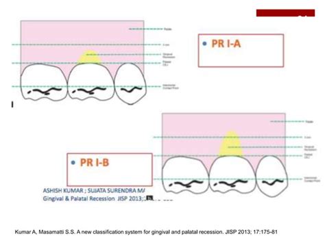 Root Coverage Procedures Dr Kinjal Ghelani Pptx