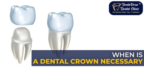 When Is A Dental Crown Necessary Common Reasons For Crown Placement Dentaverse
