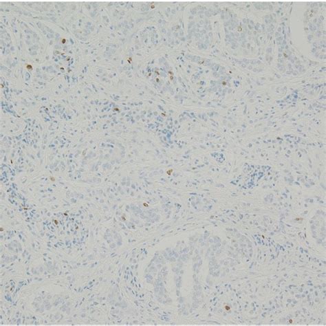 Ct Images Show Fecalith And Acute Appendicitis In Equivocal Cases