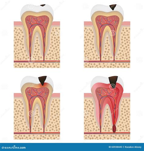 Dental Caries Formation Vector Illustration 63341194