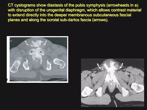 Imaging Abdomen Trauma Urinary Bladder Trauma Part 8 Dr Ahmed Esawy