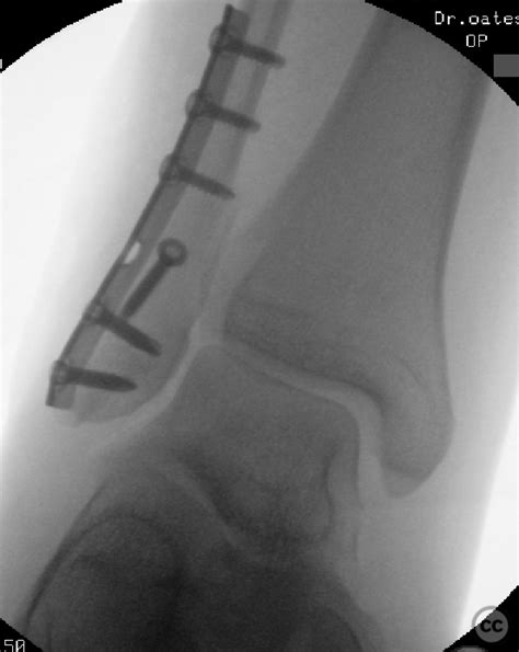 Simple Ser Weber B Fibula Fracture