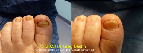 Blog Nail Fungus Expert In Melbourne Astonishing Results