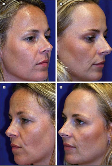 Identical Twins Reveal Surprising Results After One Used Botox For 20
