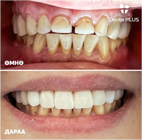 Б Хандсүрэн 🦷zirconia бүрээсээр сэргээсэн эмчилгээний үр дүн 👉🏻Энэ нь таны шүдийг илүү натурал