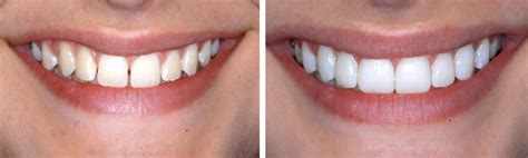 No Prep Veneers Procedure Candidates Benefits And Cost Longevita