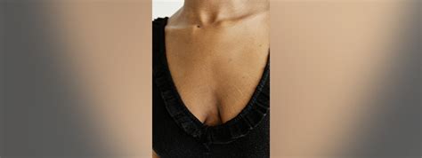 How To Reduce Stretch Marks On Breasts Naturally Clovia Blog