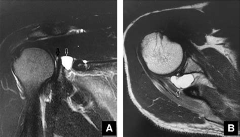 Figure 2 From Arthroscopic Decompression Of Spinoglenoid Notch Cyst And