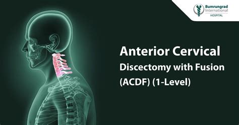 Level Acdf
