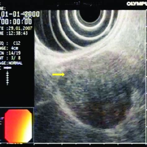 Gastric Lipoma Hyperechoic Mass Within The Submucosa Arrow