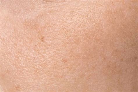 Deep Learning In Dermatology Advancing Skin Disease Diagnosis With Ai Driven Precision