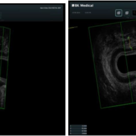 Internal And External Anal Sphincter Thickness In A Patient With