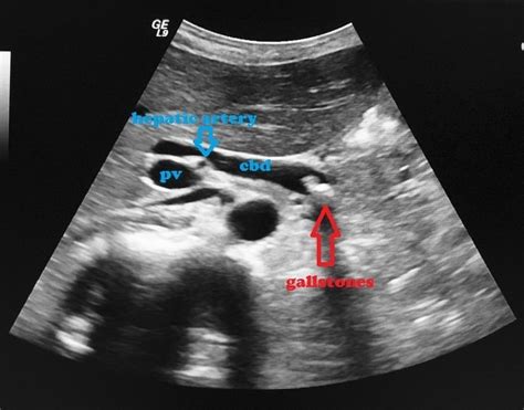 Abdominal Ultrasound