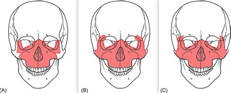 Figure 2 From Advancement Of The Midface From Conventional Le Fort III