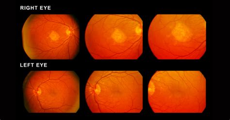 Can Machine Learning Detect Age Related Macular Degeneration