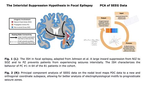 Suppressive Network Motifs Dominate Interictal Seeg Connectivity In Focal Epilepsy