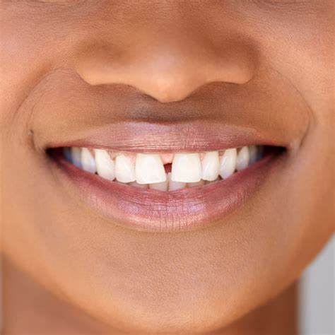 Front Teeth Gap Why Is There A Gap Between My Front Teeth